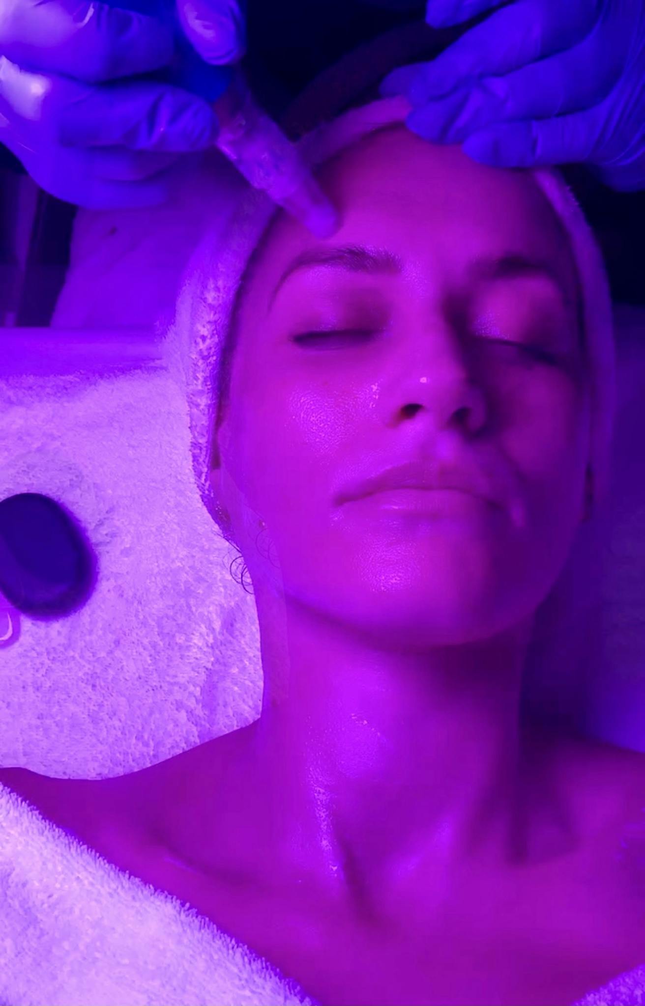 Everything You Need to Know about Micro-Needling | Gee Beauty